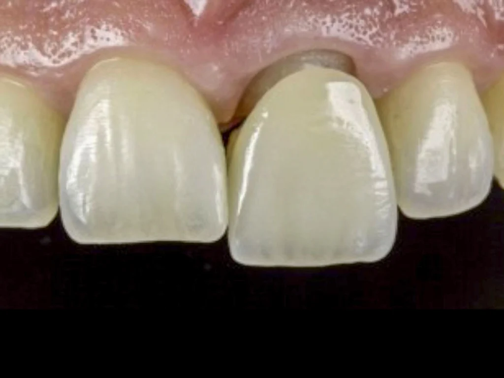 Are Same-Day Crowns as Good as Lab Crowns for You?