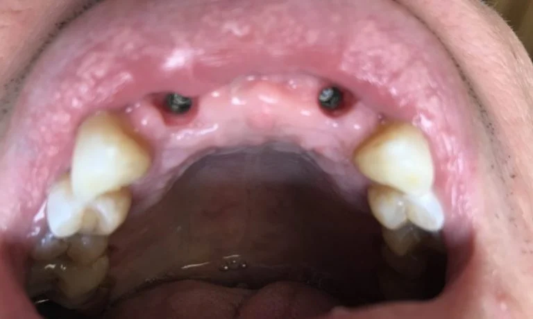 Can You Get a Same-Day Dental Bridge? What to Expect - Smile Lab
