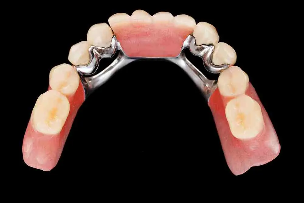 Can You Get a Same-Day Dental Bridge? What to Expect - Smile Lab