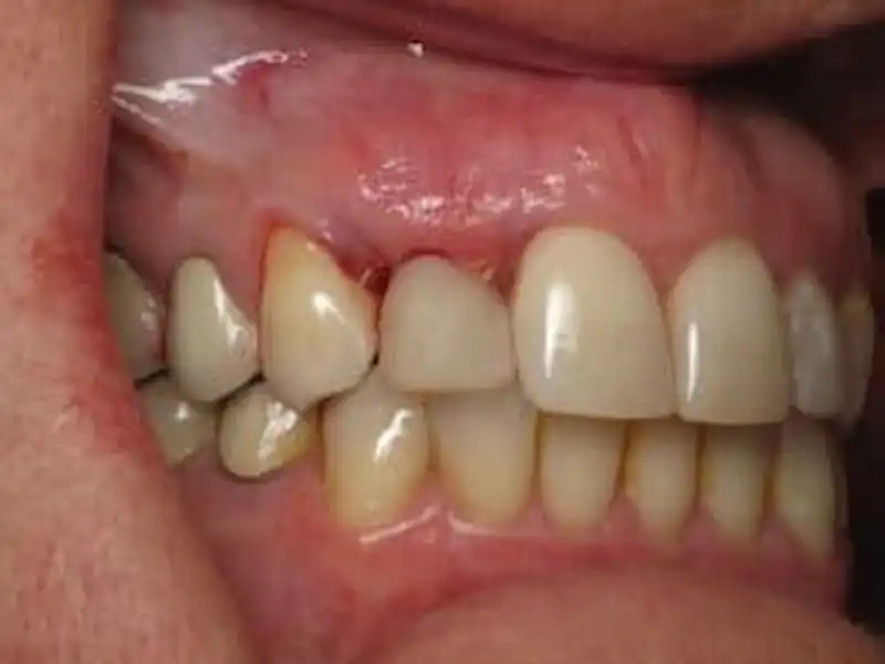 Is a Loose Dental Implant an Emergency? Crown vs Post