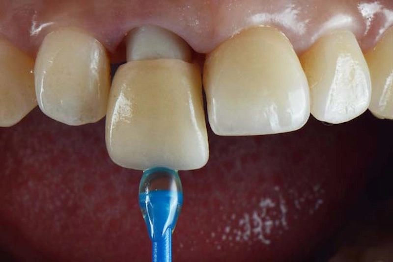 Is a Loose Dental Implant an Emergency? Crown vs Post