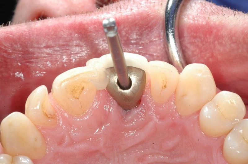 Is a Loose Dental Implant an Emergency? Crown vs Post