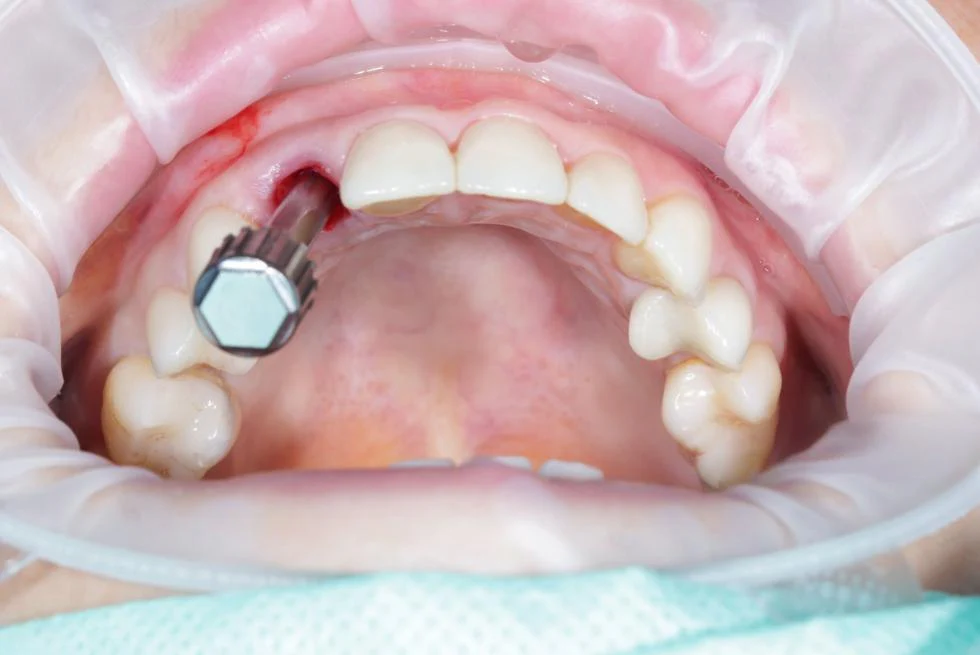 Is a Loose Dental Implant an Emergency? Crown vs Post