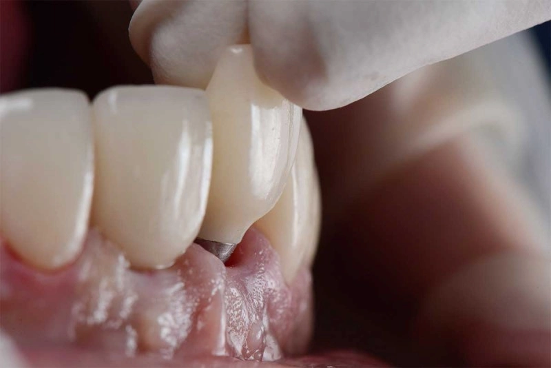 Is a Loose Dental Implant an Emergency? Crown vs Post