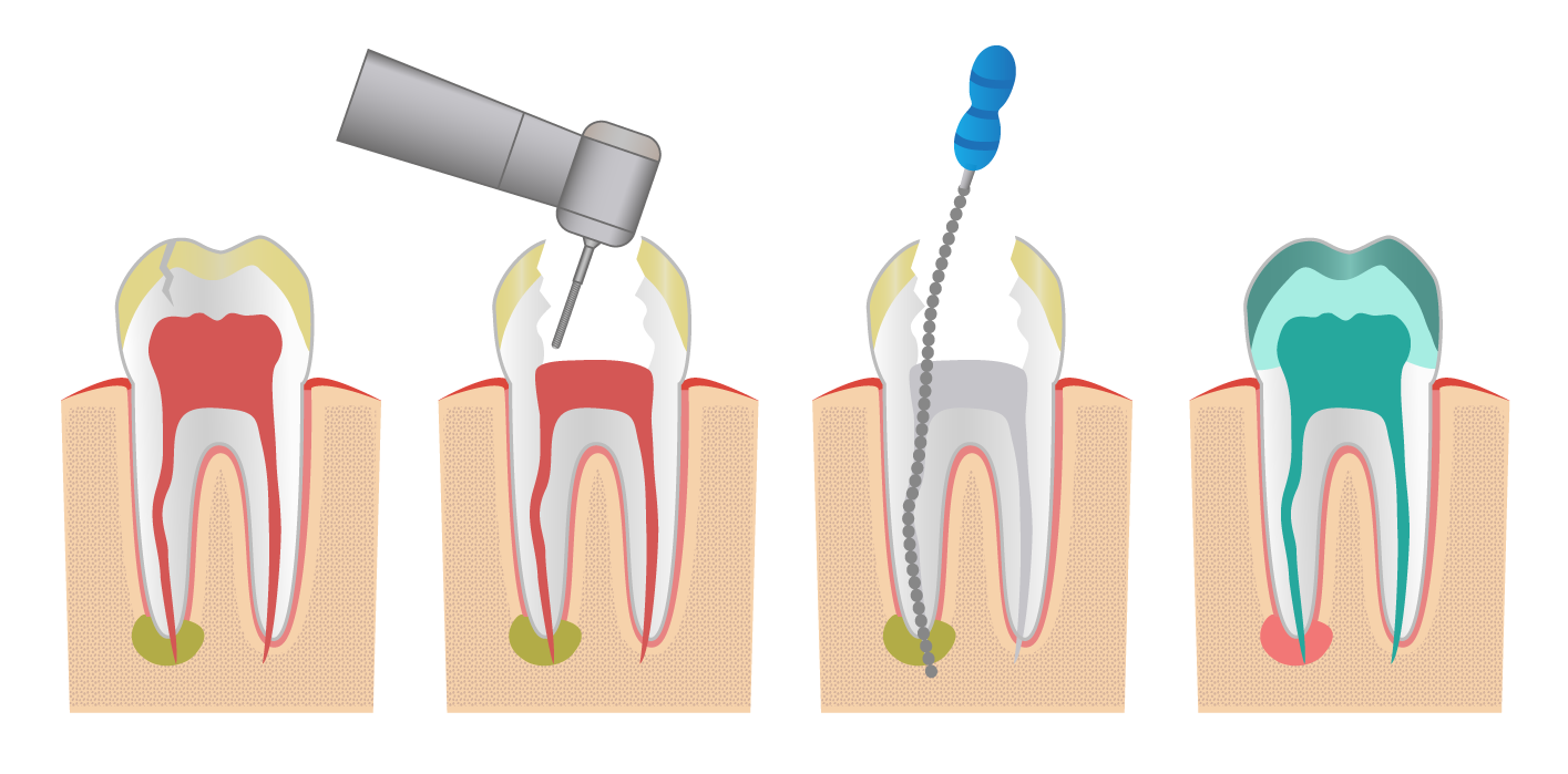 Is a Root Canal an Emergency? Symptoms to Check Today