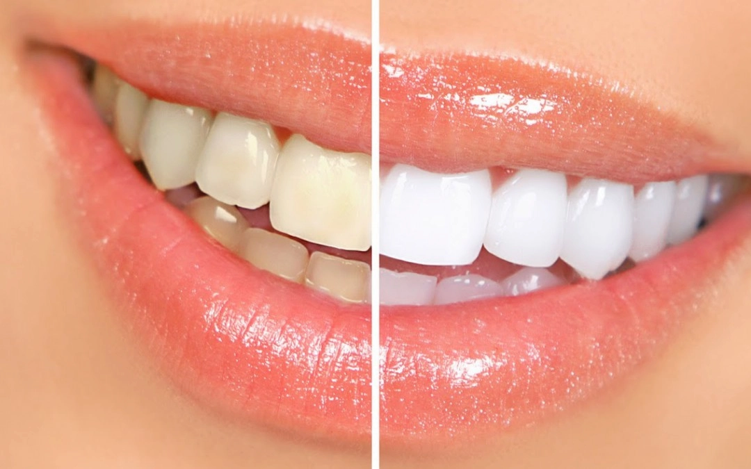 Same Day Teeth Whitening: What to Expect and How It Works