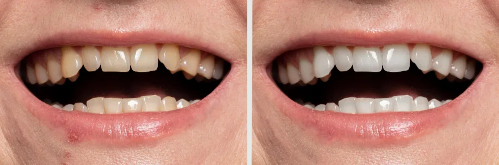 How to Remove Brown Stains from Teeth Naturally: Simple Tips for a ...